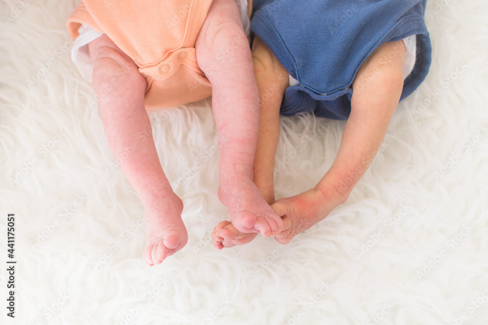 Small legs of newborn premature twins and one of baby have neonatal ...