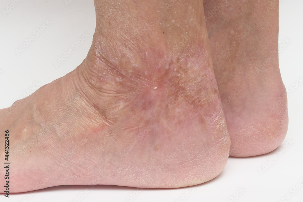 Scar on the leg from a burn after 40 years. Stock Photo | Adobe Stock