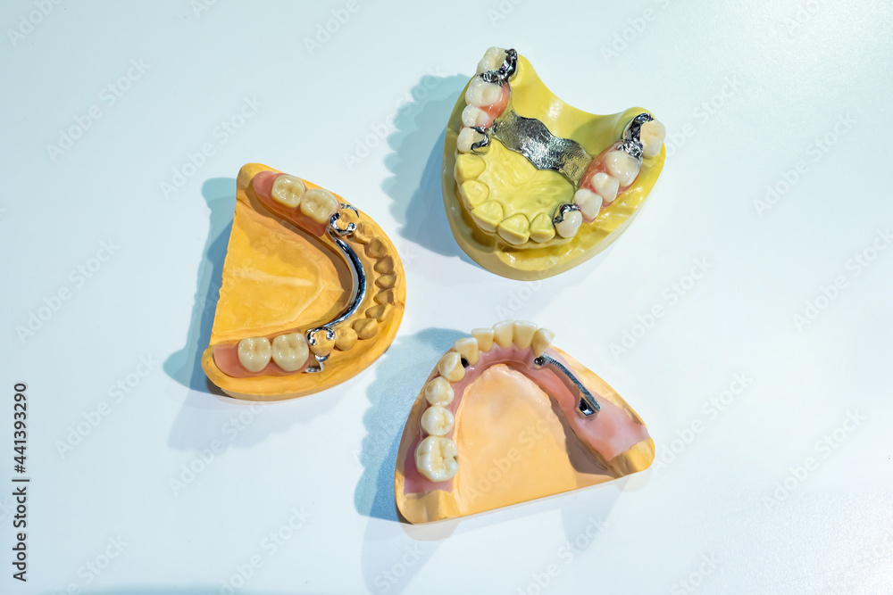 Human jaw prosthesis. Dentures with metal plates. Several options for ...