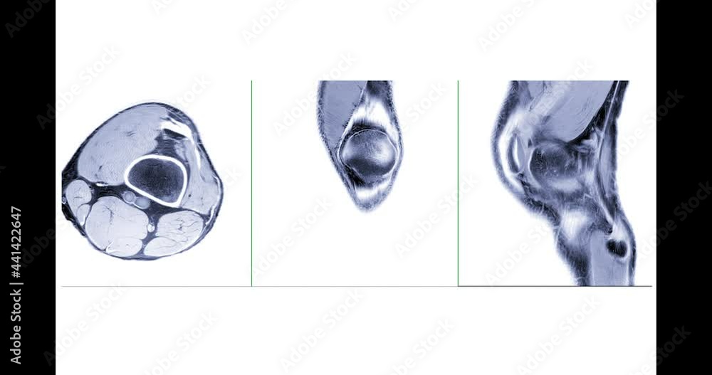 Compare of MRI knee or Magnetic resonance imaging of knee joint Axial ...