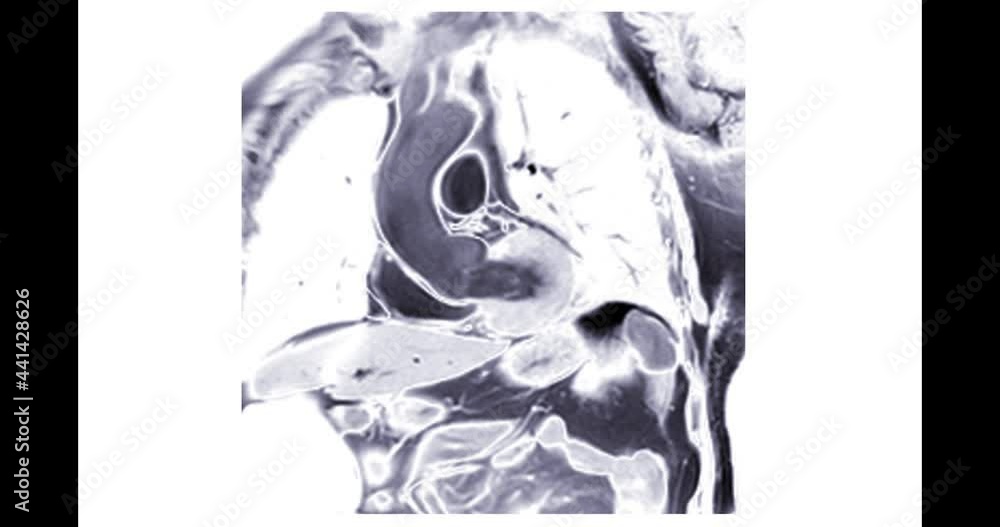 MRI heart or Cardiac MRI ( magnetic resonance imaging ) of heart in ...