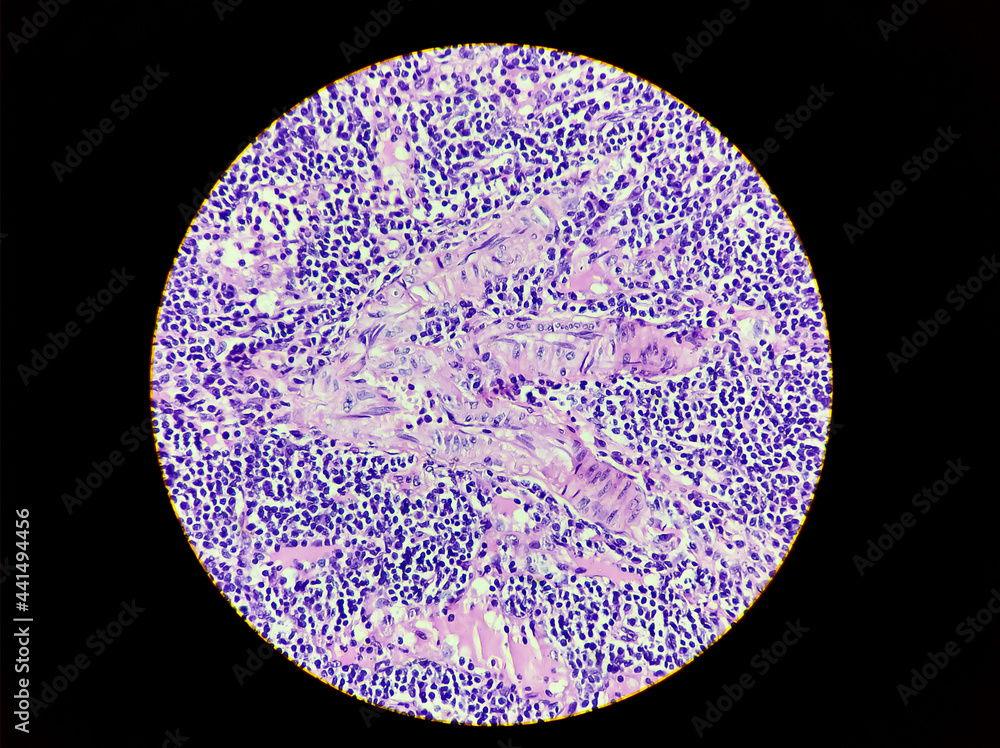 Colon cancer, photo under microscope. Light micrograph showing colon ...