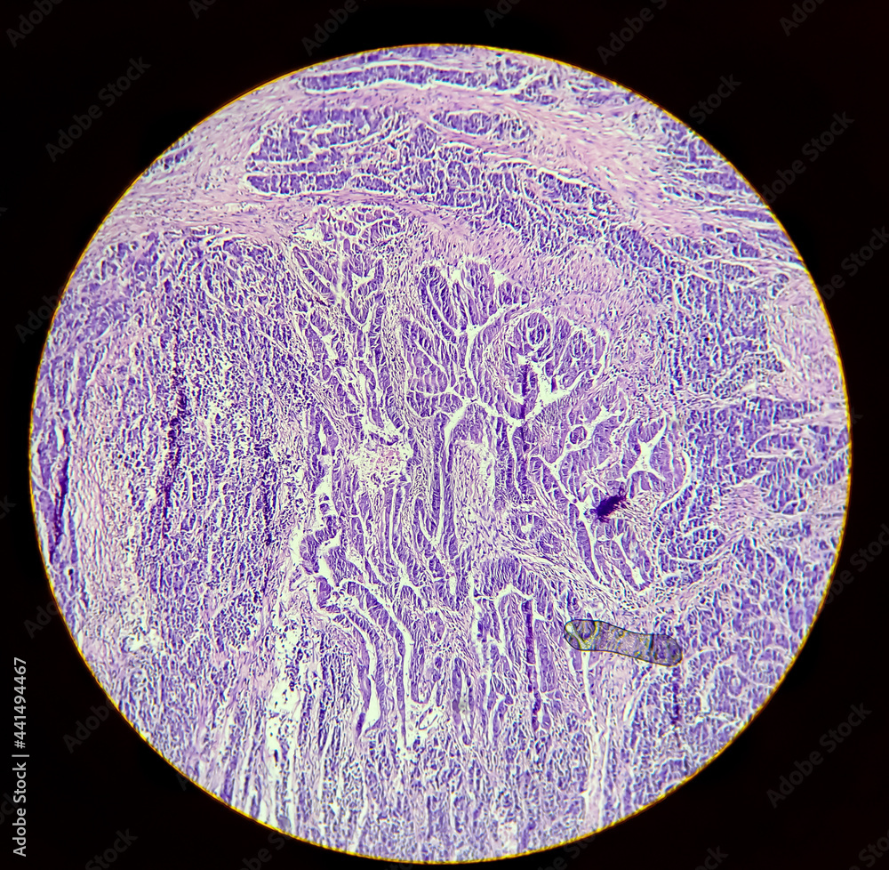 Colon cancer, photo under microscope. Light micrograph showing colon ...