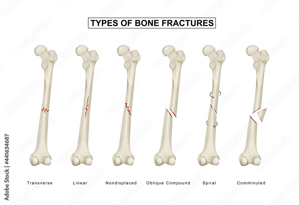 Types of bone fractures. Femoral Shaft fracture Stock Photo | Adobe Stock