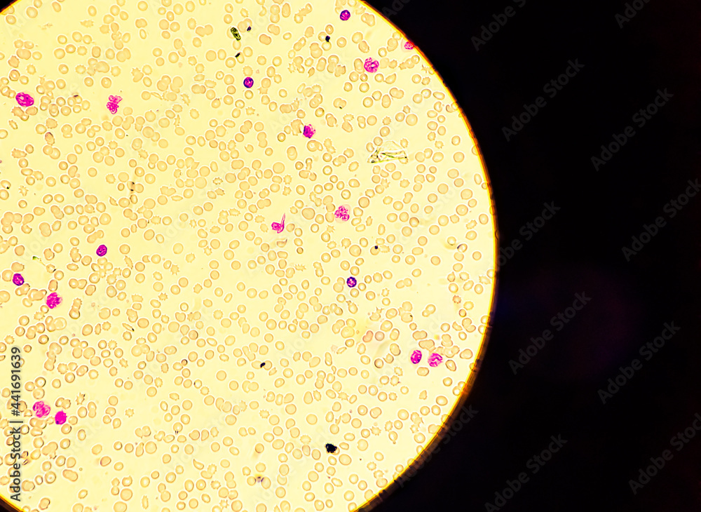 Blood smear under microscopy showing on Adult acute myeloid leukemia ...