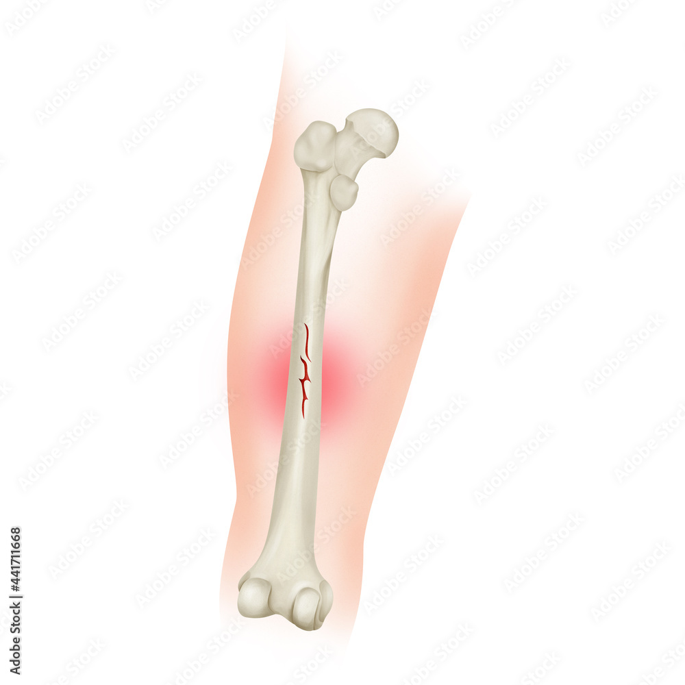 Linear bone fracture. Femoral Shaft fracture Stock Illustration | Adobe ...