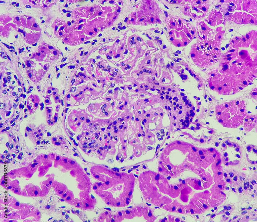 Photo of lupus nephritis, showing endocapillary hypercellularity, H&E ...