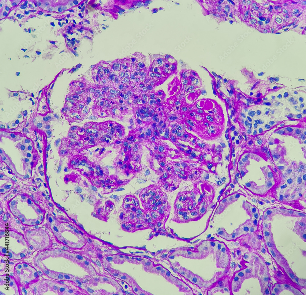 Photo of lupus nephritis, showing wire loop and hyaline thrombi, PAS ...