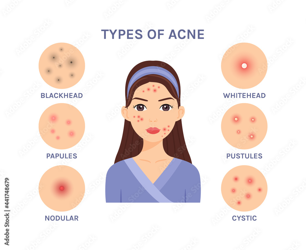 Types of acne,pimples. Isolated cute cartoon brunette girl in a ...