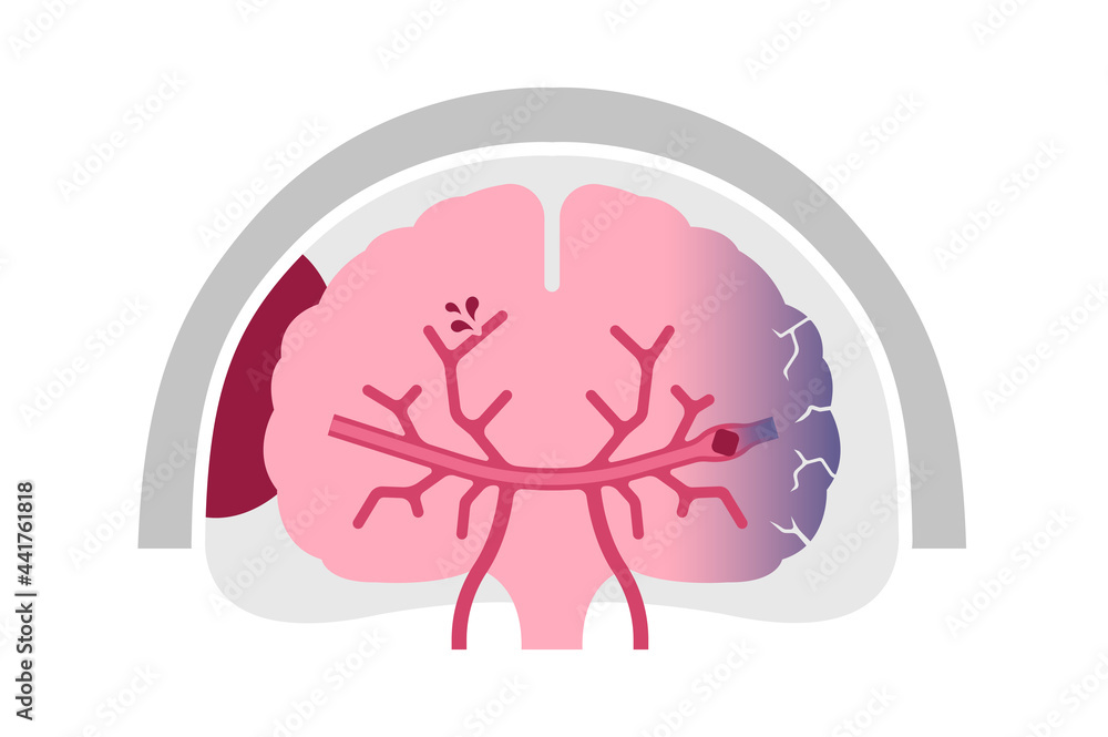 Types of human brain stroke vector illustration Stock Vector | Adobe Stock