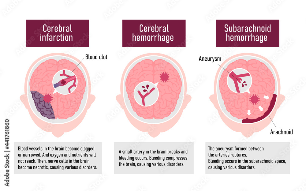 Types of human brain stroke vector illustration Stock Vector | Adobe Stock