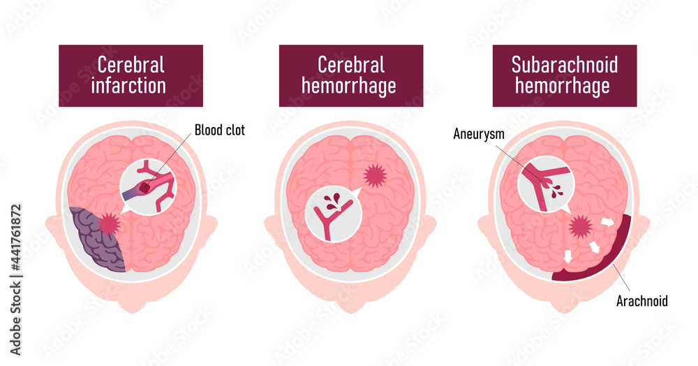 Types of human brain stroke vector illustration Stock Vector | Adobe Stock