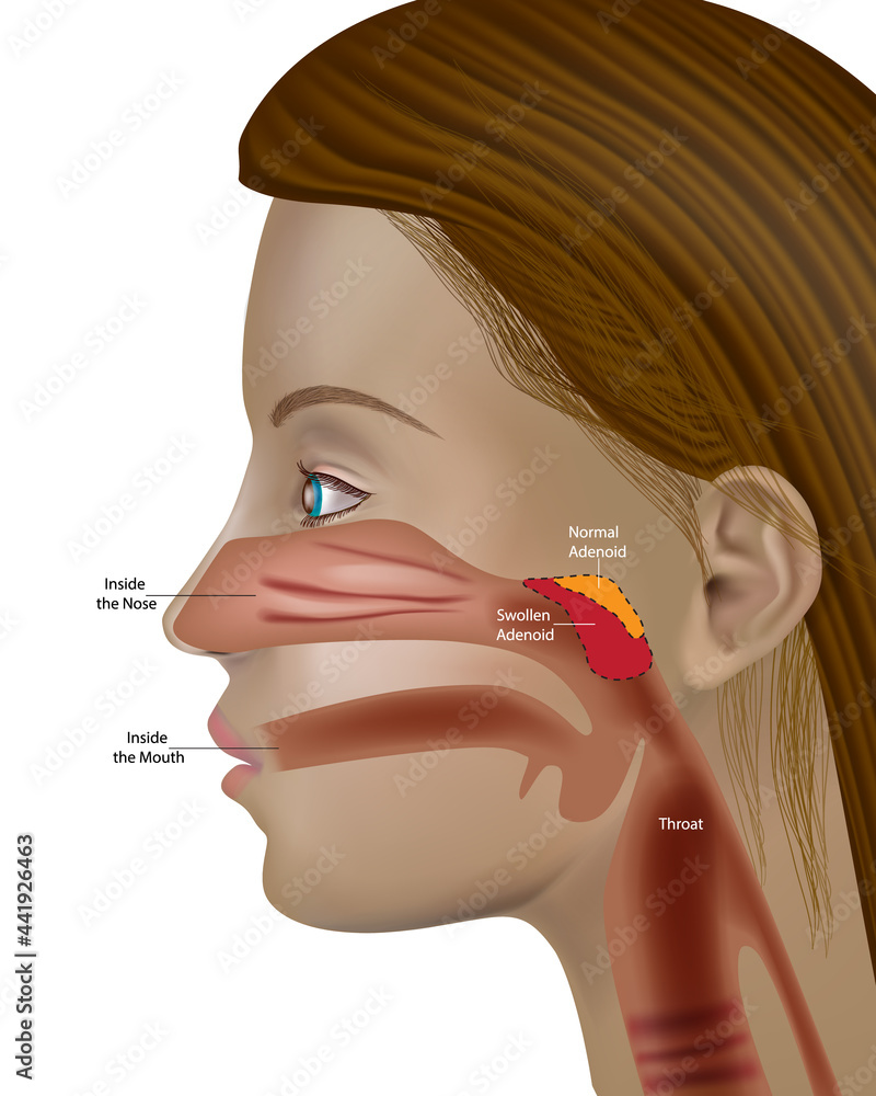 Adenoids, pharyngeal tonsil or nasopharyngeal tonsil (Human Anatomy ...