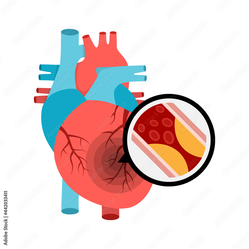 Human heart anatomy with heart attack. Atherosclerotic plaque in the ...