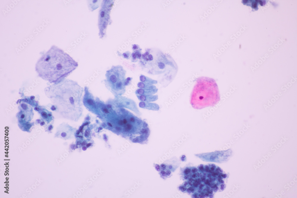 View In Microscopic Of Abnormal Human Cervix Cells Squamous Epithelium