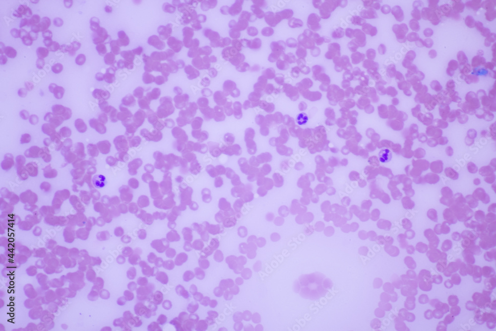 Human blood smear view in microscopy.Complete blood count for treatment ...