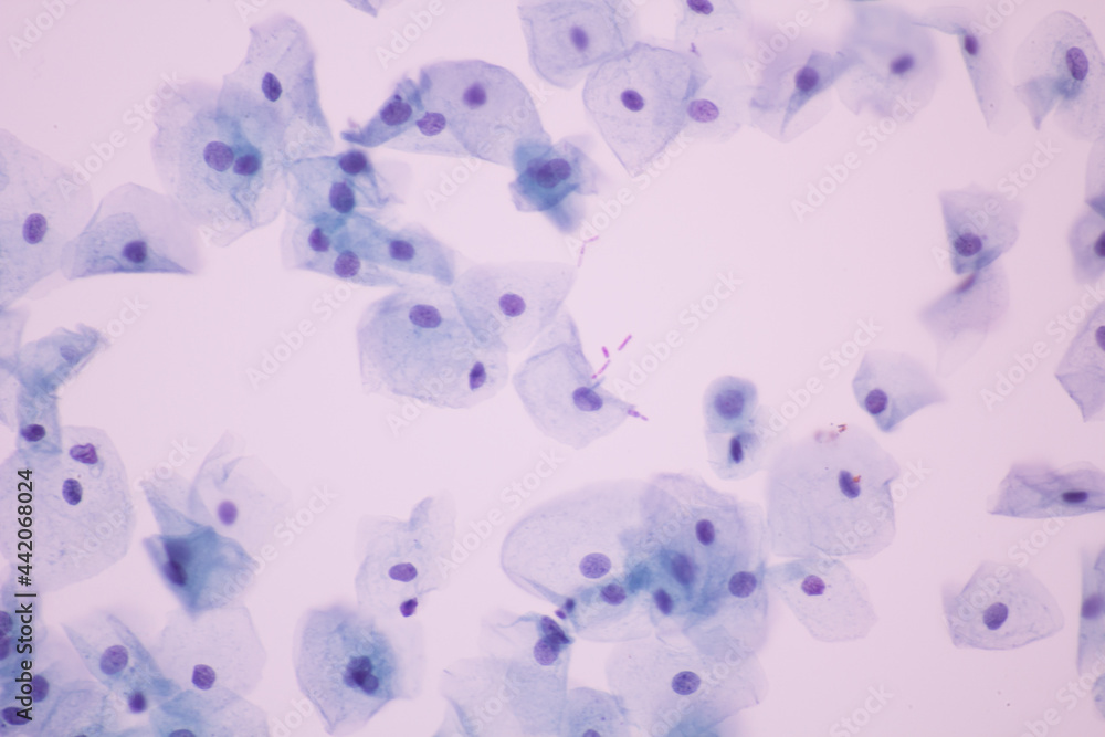 View in microscopic of Abnormal human cervix cells.Squamous epithelium ...