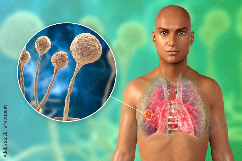 Lung mucormycosis, a lung disease caused by fungi Mucor, also known as ...