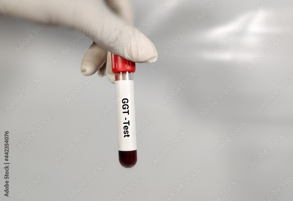 Test Tube with blood sample for GGT test, Liver enzyme. A medical ...