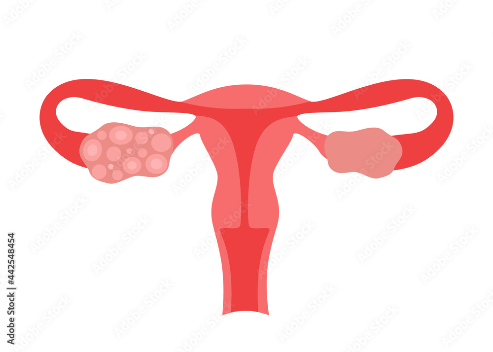 Polycystic ovary syndrome PCOS of woman. Female reproductive system ...