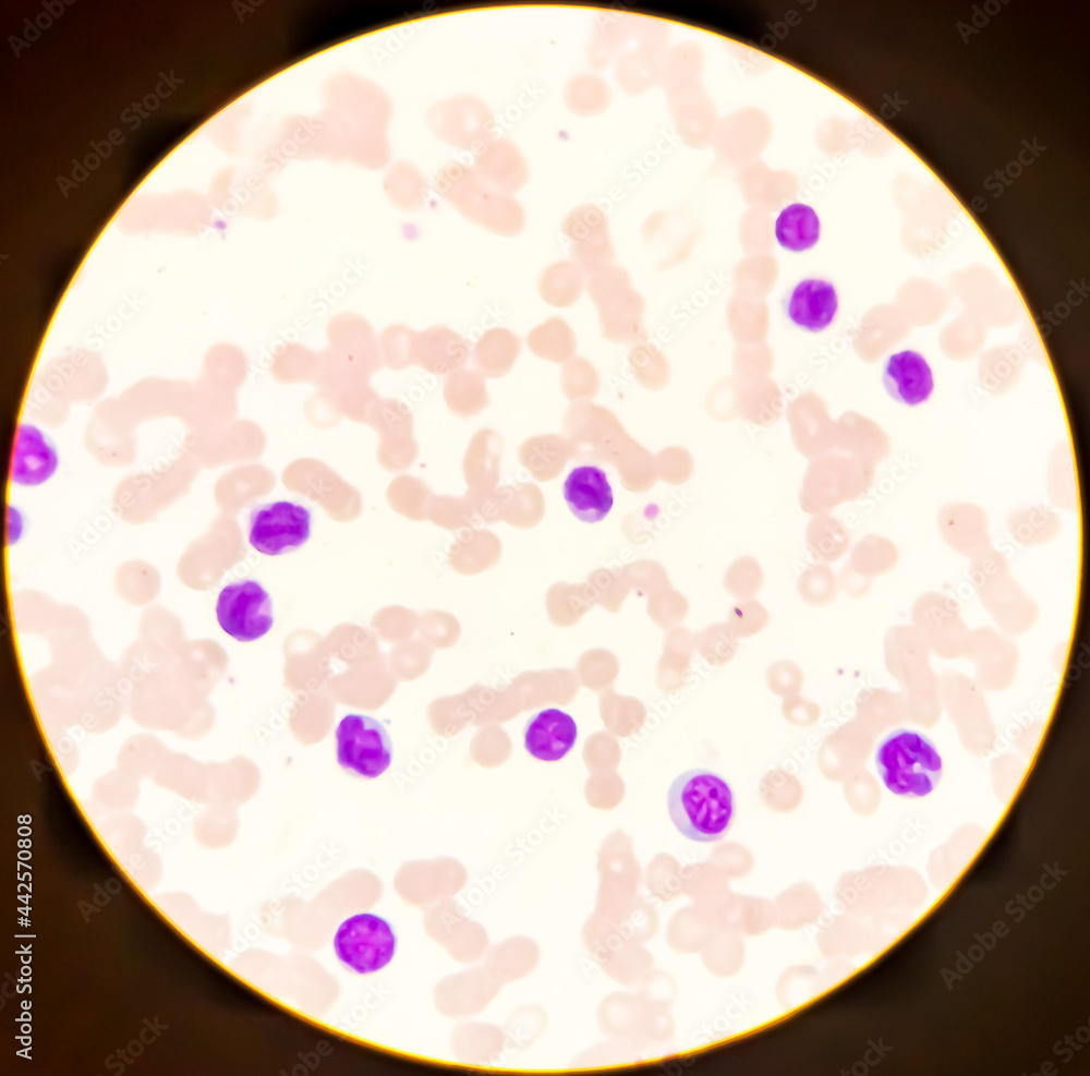 Blood picture of acute myeloid leukemia (AML),The smear shows large ...