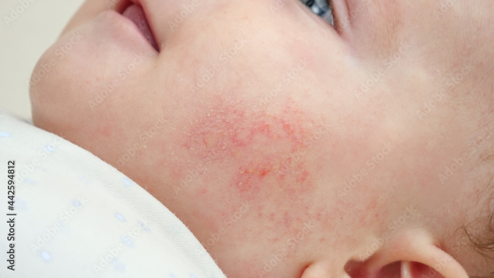 Closeup of baby face with red skin suffering from acne and dermatitis ...