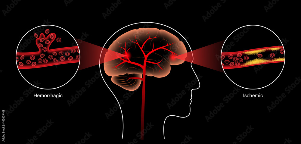 Photo & Art Print Brain stroke ishemic and hemorrhagic, pikovit