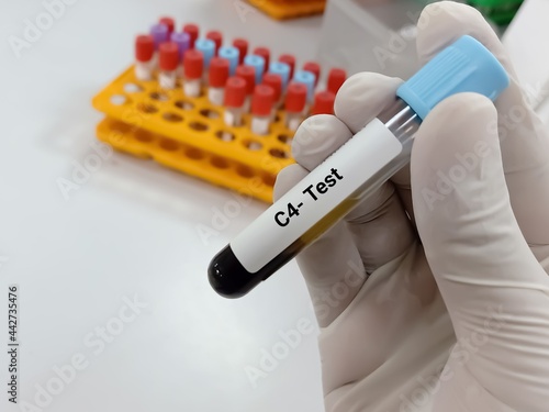 Biochemist or Lab Technologist holds Blood samples for protein C test ...