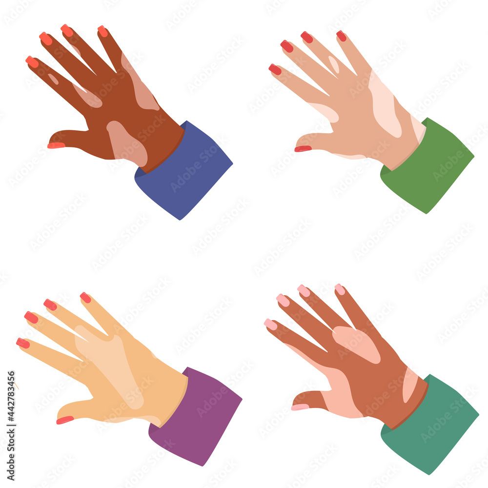 vector illustration of hands with different skin color with vitiligo ...