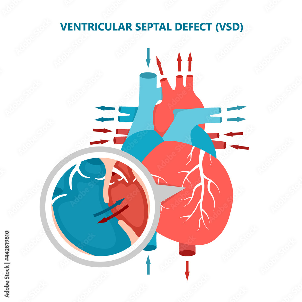 Ventricular septal defect VSD with heart blood flow. Human heart muscle ...