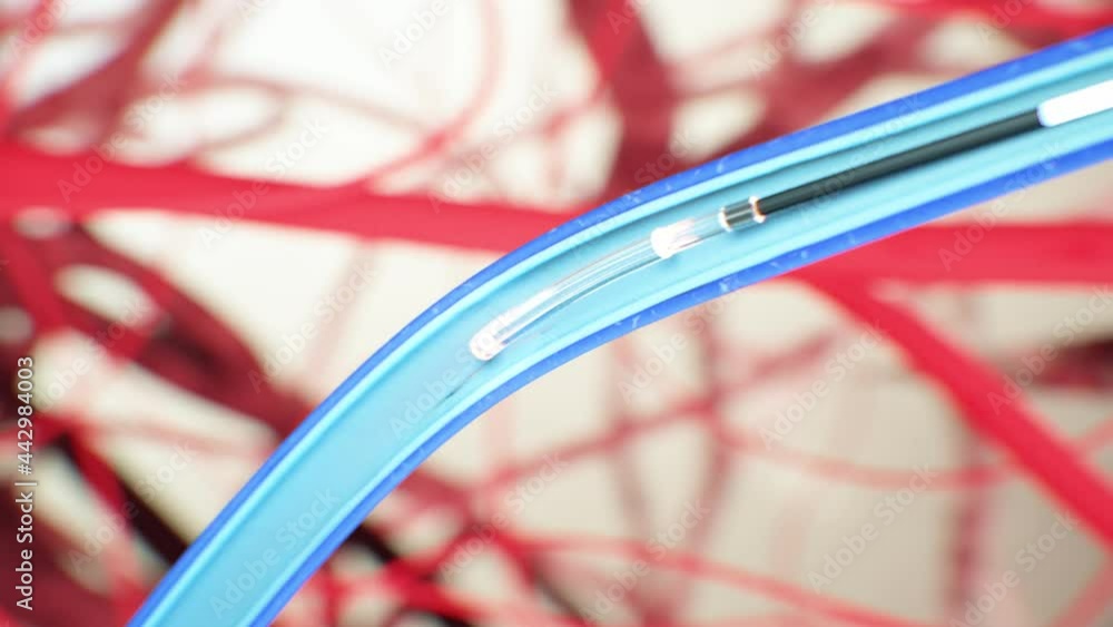 Laser surgery to remove varicose veins, laser insertion into a vein ...