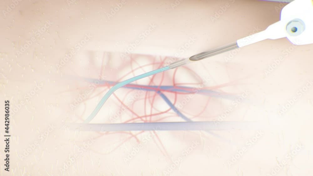 Laser surgery to remove varicose veins, laser insertion into a vein ...