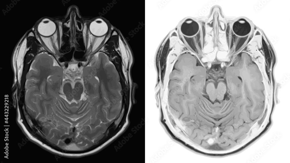 Photo Realistic cross section of brain with CT scan, MRI Magnetic ...
