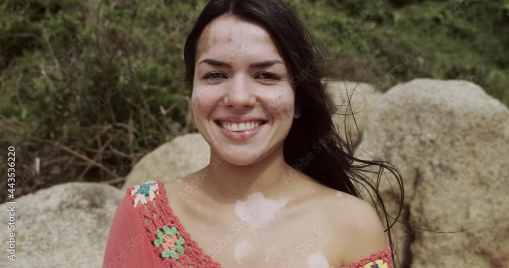 Vidéo Stock Beautiful latin girl with vitiligo on the beach. World ...