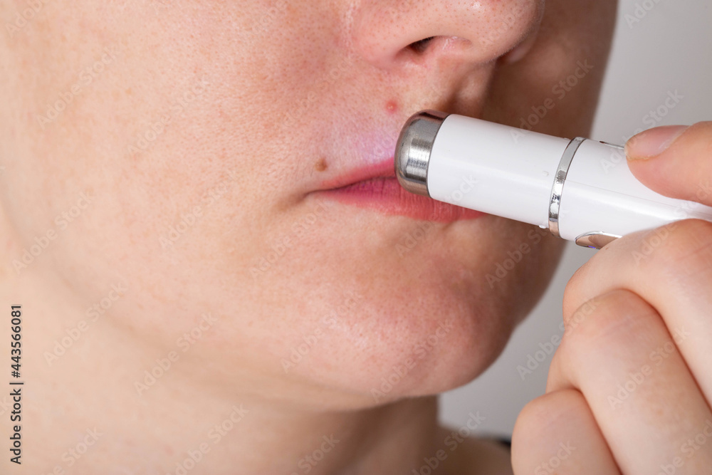 Girl treats inflamed red acne on the skin of the face with a laser ...