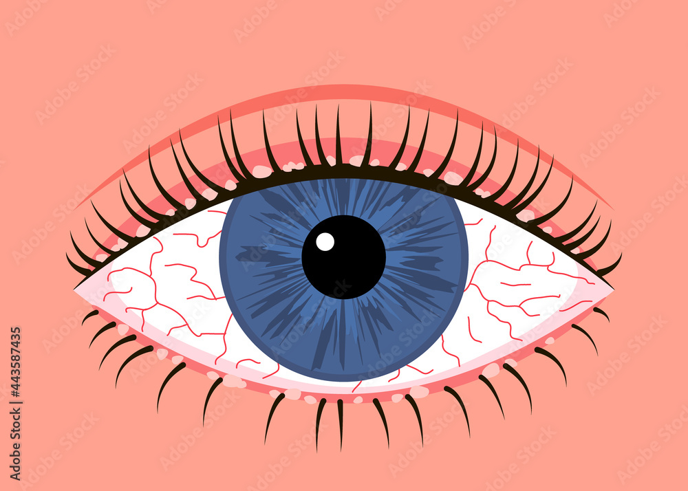 Inflamed sick human eye with blepharitis, allergy symptom red veins ...
