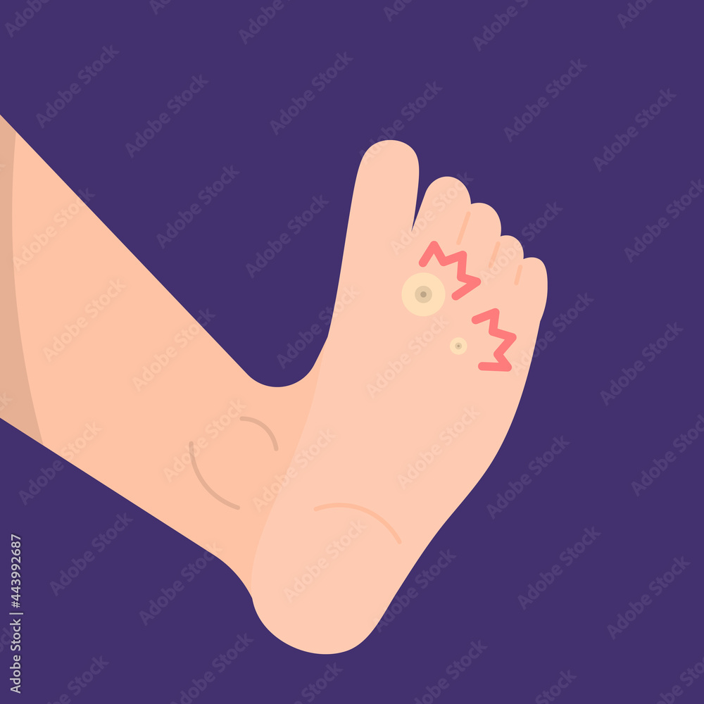 illustration of a foot affected by fish's eye disease or clavus. skin ...