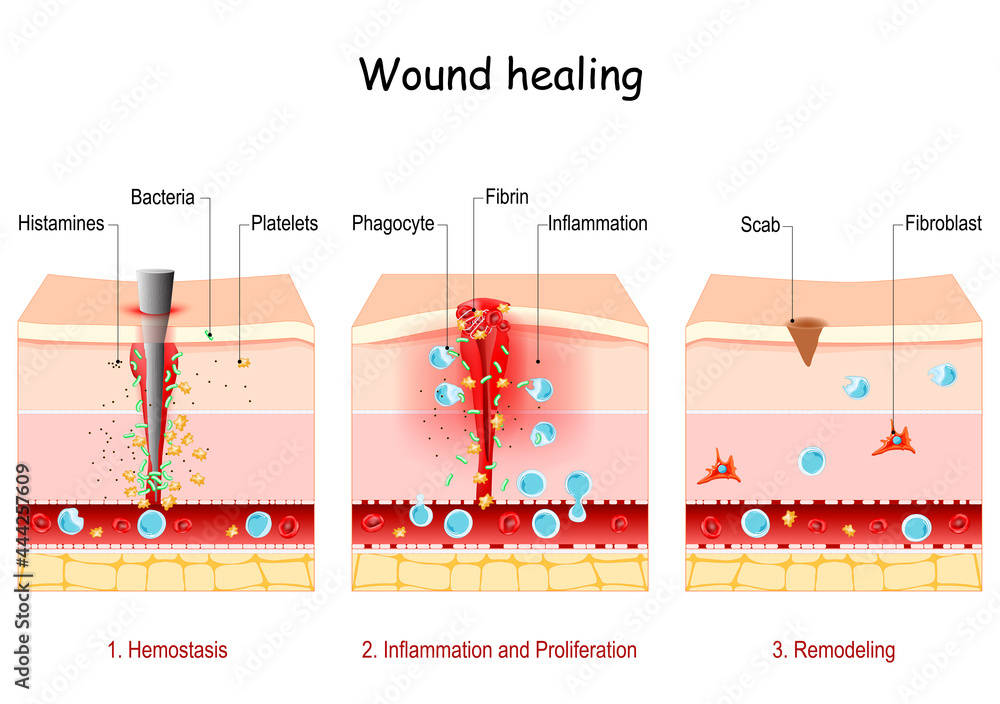 Wound Healing Stages Of The Post trauma Repairing Process Stock Vector wound-healing-stages-of-the-post-trauma-repairing-process-stock-vector