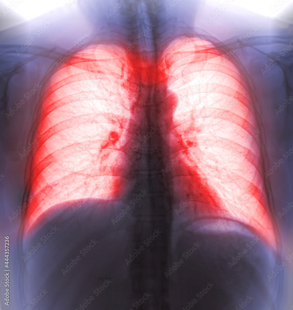 Chest X-ray or X-Ray Image Of Human Chest or Lung ( red zone ) showing ...