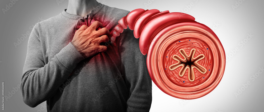 Asthma Attack as an unhealthy bronchial tube suffering of a ...