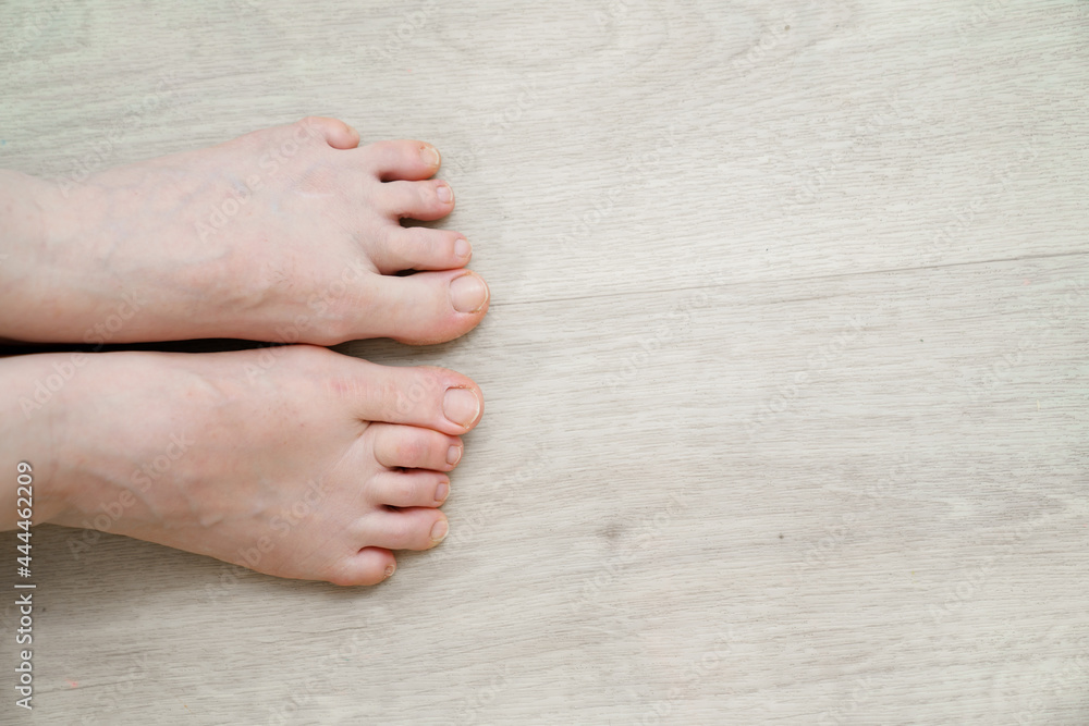 unusual foot. very small little finger on the leg. orthopedic ...