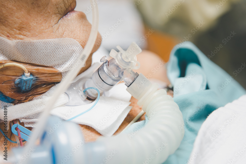 Patient do tracheostomy and ventilator in hospital Stock Photo | Adobe ...