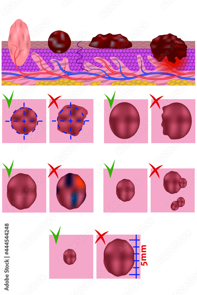 The anatomical structure of a mole and melanoma. Skin cancer prevention ...