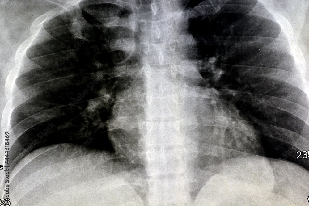 Bronchitis Lung X Ray