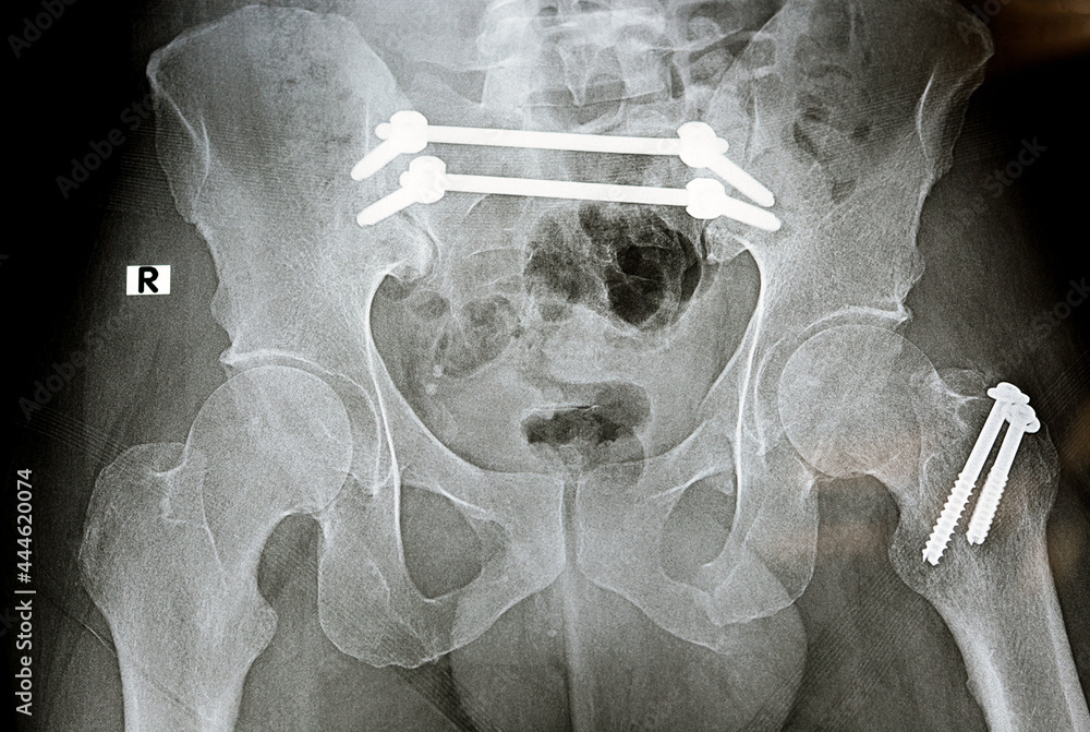 Broken Pelvis From Car Accident
