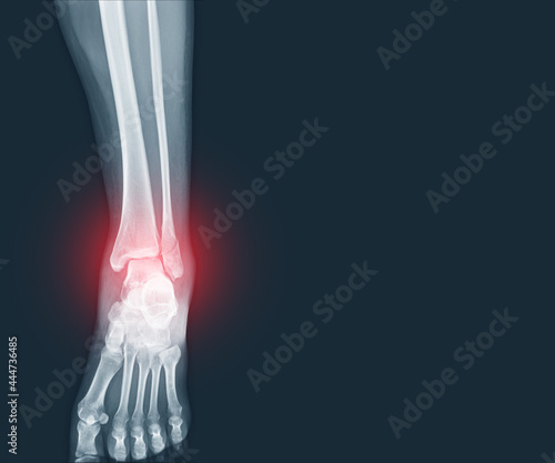 Film x-ray Ankle and Foot fracture distal fibula bone with soft tissues ...