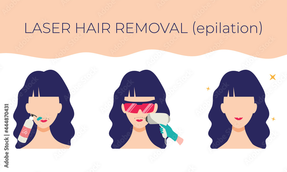 Laser hair removal on the face. Stages of the procedure. Vector ...
