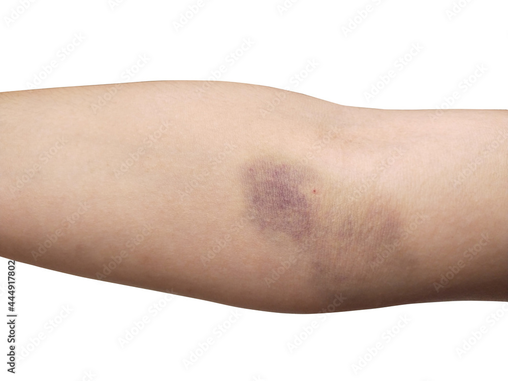 Bruises from injections. Bruise. Scar from vaccination on arm. skin re ...