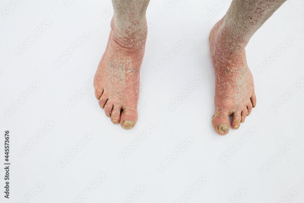 The doctor diagnoses the injured foot. Dry skin, Psoriasis of the feet ...