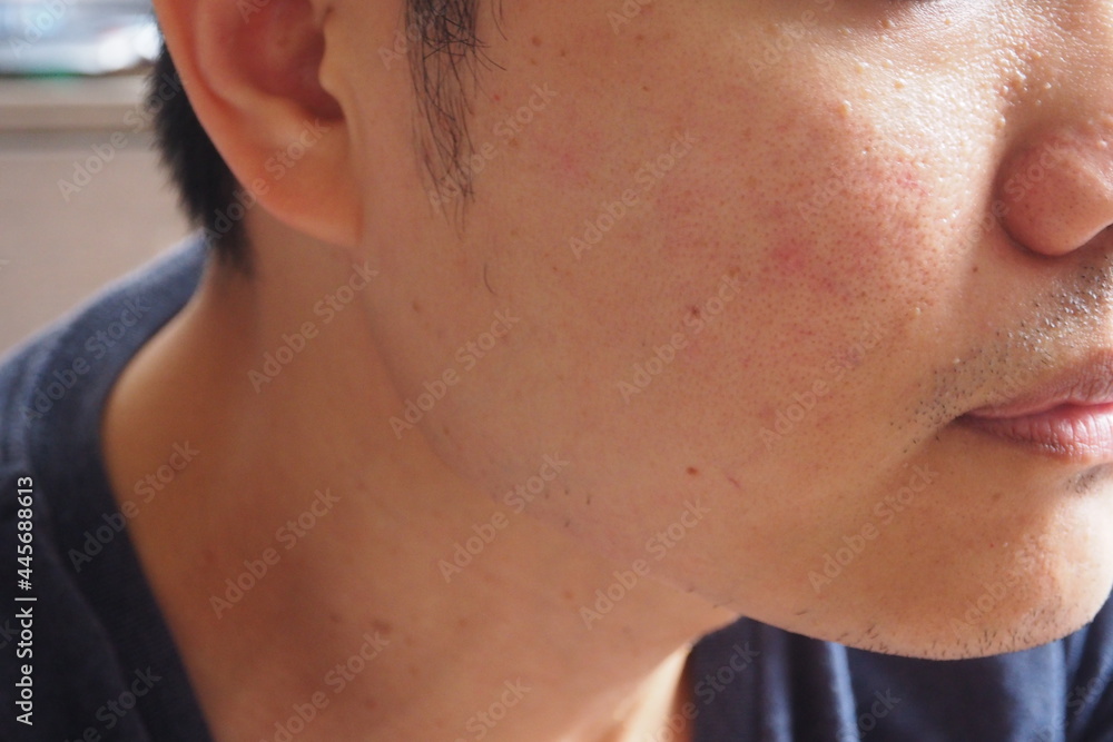 Red skin with acne pores and moles on the face of a young man for ...